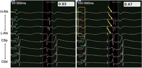 Intracardiac Electrogrambased Atrial Pace Mapping For Detecting The Earliest Activation Site In