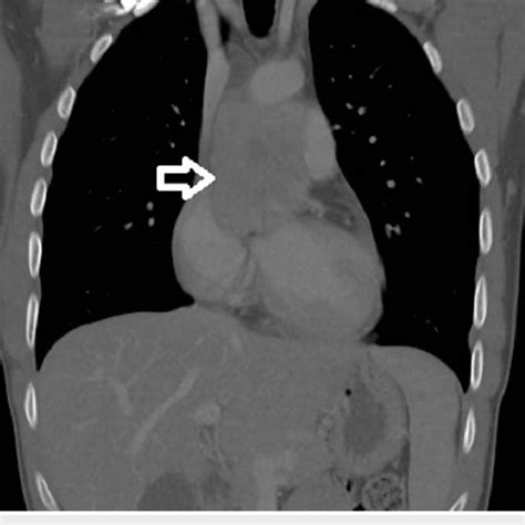Pathologic Fracture Of The Lumbar Spine Pathologic Compression Download Scientific Diagram