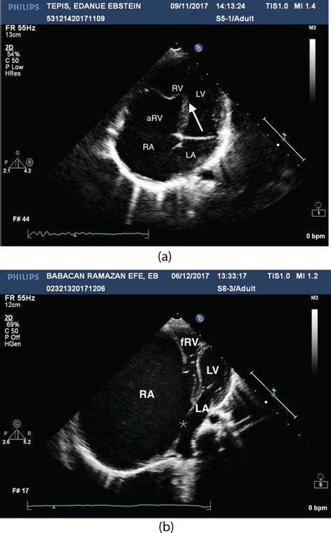 Ebstein Anomaly Echo Fetal Echocardiogram With Color Compares