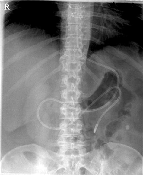 Raio X De Sonda Nasoenteral Braincp