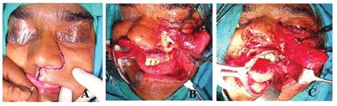 Showing Surgical Steps Performed In Doing Left Partial Infrastructure Download Scientific