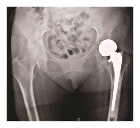 A A 61 Year Old Female Sustained A Syncopal Fall At Home Resulting In Download Scientific