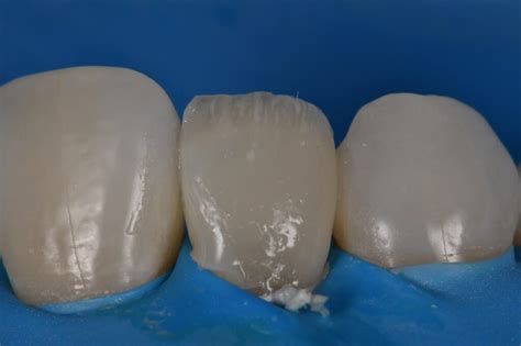 Generating Translucency And Window Effects In A Composite Veneer