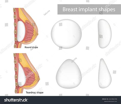 Different Breast Implant Shapes