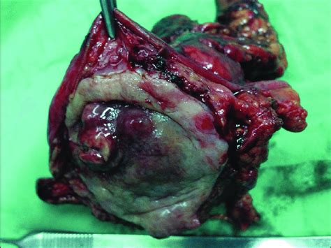 Macroscopic Partial Cystectomy Sample Image Download Scientific Diagram