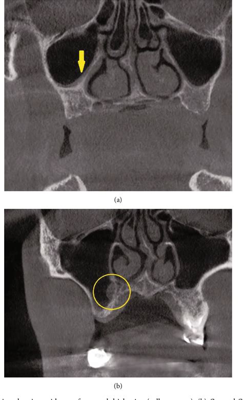Figure 3 From Application Of A Cone Beam Computed Tomography Based Index For Evaluating Surgical