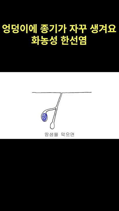 엉덩이종기질환 화농성한선염 예스항외과 Youtube