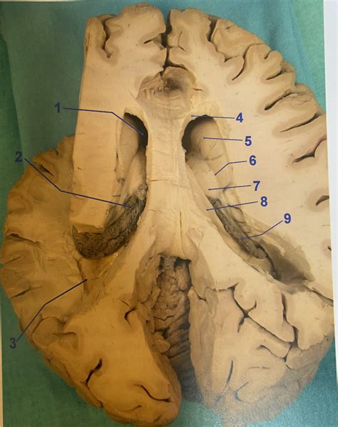 P 385 Lateral Ventricle Superior View Diagram Quizlet