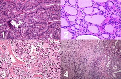 Thyroid Cancer Types Management TeachMeSurgery