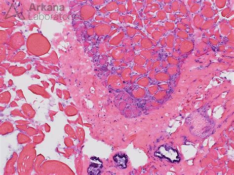 Calciphylaxis Neuro Notes Arkana Laboratories