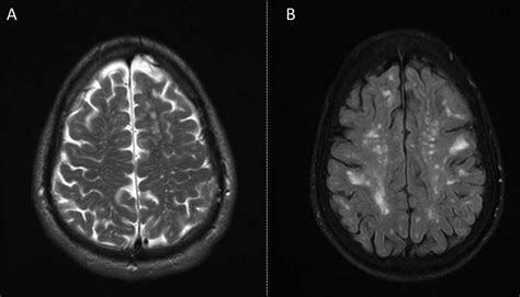Cerebral Amyloid Angiopathy Causes Symptoms Diagnosis Treatment