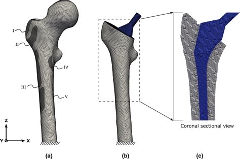 Fe Models Of The Intact And Implanted Femurs A Intact Femur B