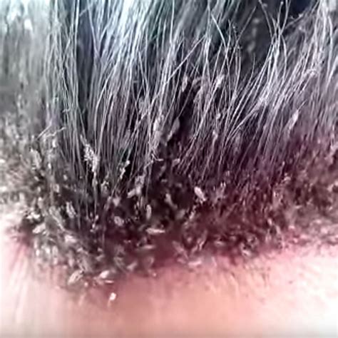 Girl 9 Dies After Mother Applied Pesticide On Her Lice Infested Hair Forum The Nation