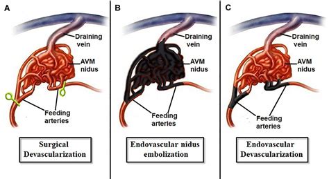 Best Vascular Malformation Treatment In Hyderabad Vm