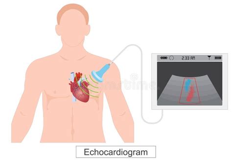 An Echocardiogram Echo Is A Test That Diagnoses And Manages Heart