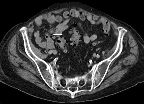 Ileal Diverticulitis Journal Of The Belgian Society Of Radiology