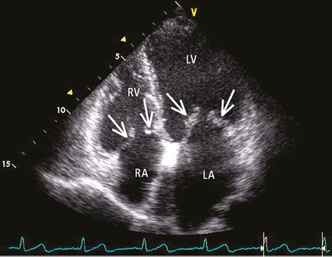 Figure 031 6396 Transthoracic Echocardiography Tte Apical 4 Chamber View Mitral Valve