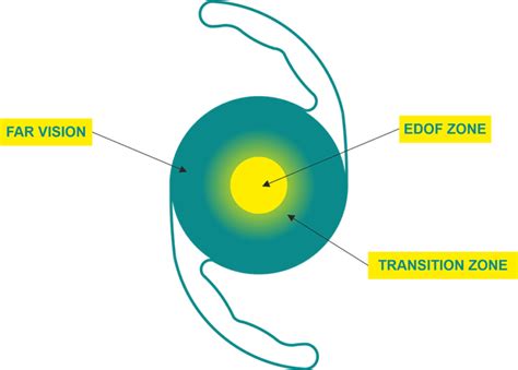 Edof Hydrophobic Iol Freedom Ophthalmic