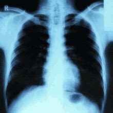 X Ray S Tenor