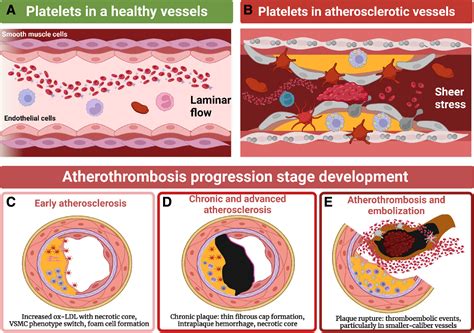 Platelets In Thrombosis And Atherosclerosis The American Journal Of