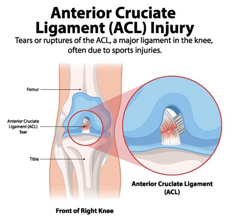 前十字韧带（acl）撕裂 Hc 骨科手术