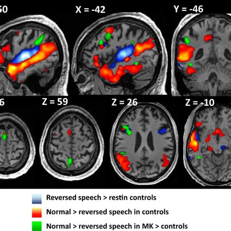 Dynamic Causal Modelling Of Ticker Tape Synesthesia Tts Most Likely