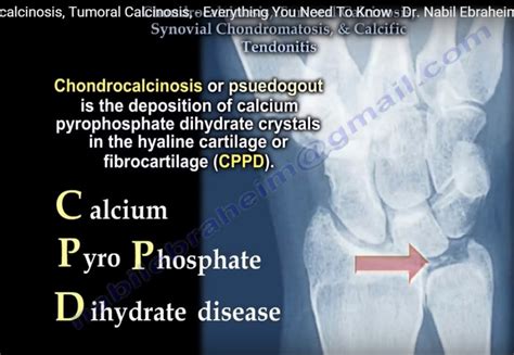 Chondrocalcinosis —