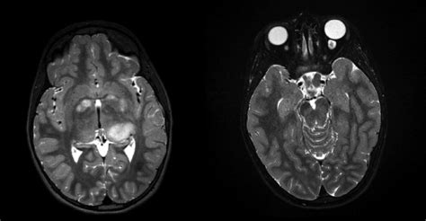 Optic Visual Pathway Gliomas Neupsy Key