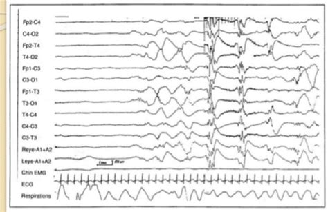 Normal Preterm Neonates Eeg Part One Flashcards Quizlet