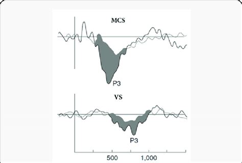 differential diagnosis value of p300 component in response to the own