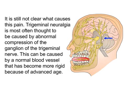 Trigeminal Neuralgia Balloon Compression