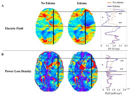 Peritumoral Edema Induces A Spatially Heterogenous Distribution Of A Download Scientific