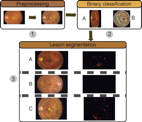 Figure 1 From Retinal Lesion Segmentation Using Transfer Learning With An Encoder Decoder Cnn