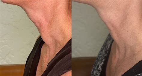 Rfa Success Stories Thyroid Nodule Treat