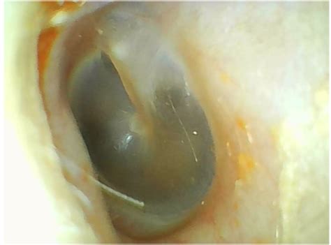 Otitis Media Or Glue Ear — Hearing Institute Tinnitus Specialists