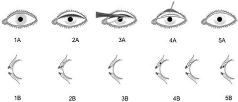 Schematic Drawing Of The Steps For The Split Lamellae Marginal