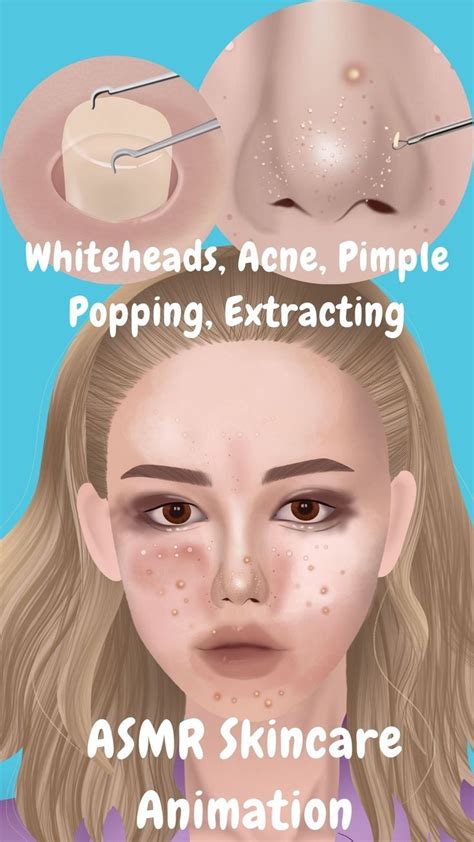 Pimple Extraction Artofit