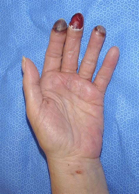 Digital Necrosis After Lidocaine And Epinephrine Injection In The