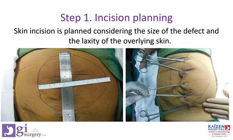 Component Separation Technique For A Very Large Abdominal Wall Hernia Pdf