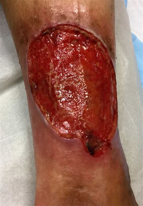 Early Pyoderma Gangrenosum