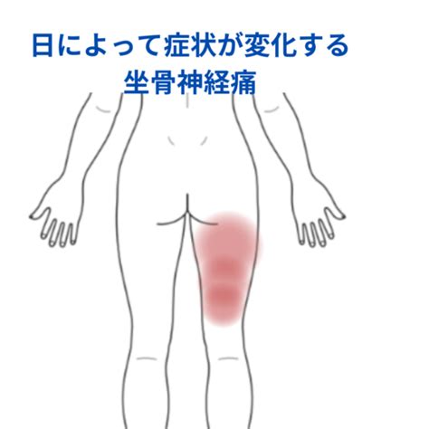 坐骨神経痛｜大腿の痛みのツボ｜ツボネット 鍼灸の症例が検索できるツボ辞典