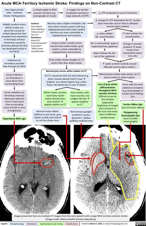 Acute Mca Territory Ischemic Stroke Findings On Non Contrast Ct Calgary Guide