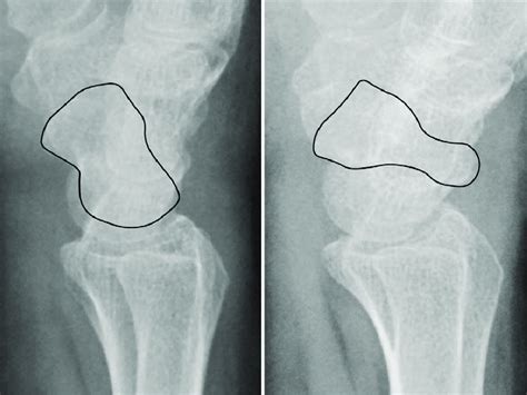 Measurement Of The Area Reduction Ratio Of The Scaphoid On Lateral View Download Scientific