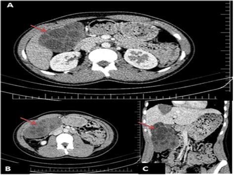 Pdf A Rare Case Of Hepatic Hydatid Cyst In Somalia A Case Report 2024 Mohamed Mohamud