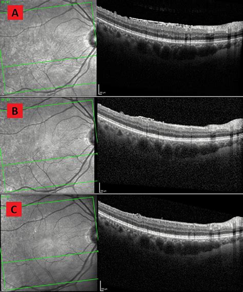 Serial Oct Evaluations Showing Spontaneous Regression Of Idiopathic Erm Download Scientific