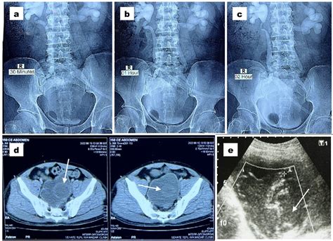 Figure 1 From Primary Hydatid Cyst Of The Urinary Bladder With