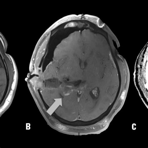 Pdf Use Of Intraoperative Mri For Resection Of Gliomas