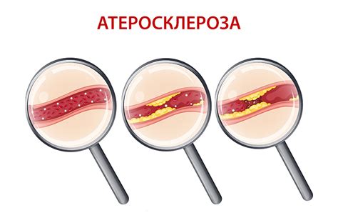 Какво е атеросклероза Какво е атеросклероза