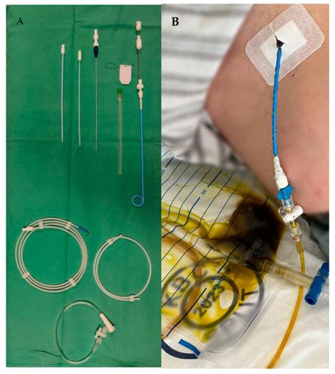 Assessment Of Gallbladder Drainage Methods In The Treatment Of Acute