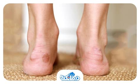 پینه پا؛ علت، علائم، عوارض، تشخیص، پیشگیری و درمان کاربردی